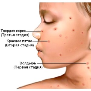 Шрамы после ветрянки: причины, способы устранения